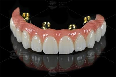 China All On X Implant Retained Bar with Screw Retained Zirconia Bridge Engineered To Deliver Superior Retention And Stability Chinese Dental Lab for sale