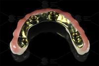 China All On X Implant Retained Bar with Screw Retained Zirconia Bridge Engineered To Deliver Superior Retention And Stability Chinese Dental Lab for sale