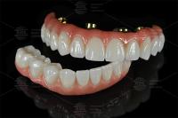 China All On X Implant Retained Bar with Screw Retained Zirconia Bridge Engineered To Deliver Superior Retention And Stability Chinese Dental Lab for sale