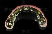 China All On X Implant Retained Bar with Screw Retained Zirconia Bridge Engineered To Deliver Superior Retention And Stability Chinese Dental Lab for sale
