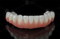 China All On X Implant Retained Bar with Screw Retained Zirconia Bridge Engineered To Deliver Superior Retention And Stability Chinese Dental Lab for sale