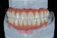 China All On X Implant Retained Bar with Screw Retained Zirconia Bridge Engineered To Deliver Superior Retention And Stability Chinese Dental Lab for sale