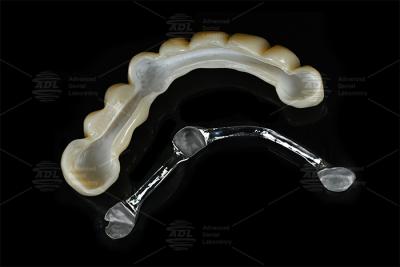 China Customizable Reinforcement Titanium Bar Combined with Milled Zirconia providing dental implant framework solutions for sale