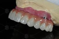 China China Dental Lab Fast Turnaround Time In 72 Hours Provides High Quality All on X for sale