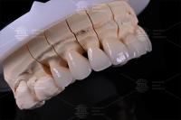 China China Dental Lab Porcelain Fused To Zirconia High Strength Providing Tailored Services To International Dental Lab And Dentist for sale