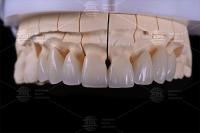 China China Dental Lab Porcelain Fused To Zirconia High Strength Providing Tailored Services To International Dental Lab And Dentist for sale
