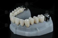 China China Dental Lab Outsource Dental Lab Ti Reinforcement Bar With Full Zirconia Providing Competitive Pricing With Volume Discounts Tailored To Dental Professionals Requiring And Manufacturing for sale