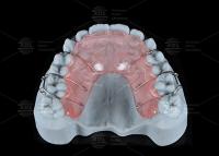 China China Dental Lab Stainless Steel And Acrylic Orthodontic Hawley Retainer For Orthodontic Treatment for sale