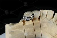 China China Dental Lab Adjustable Patient Specific Keyway Precision Attachment with PFM for sale