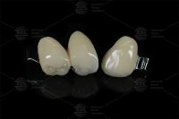 China China Dental Lab Adjustable Patient Specific Keyway Precision Attachment with PFM for sale