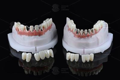 China China Dental Lab Titanium Full Arch Hybrid Bridge with Immediate Loading A1 Shade Malong Design Screw Retained Cad/Cam for sale
