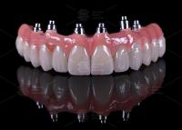 China China Dental Lab Titanium Screw Retained Malong Design A1 Shade Full Arch Hybrid Bridge for sale