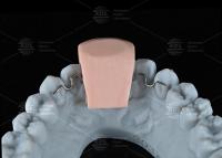 China China Dental Lab Invisible Strong U Shape Lingual Wire Retainer Single Strand Comfort Level for Orthodontic Treatment for sale