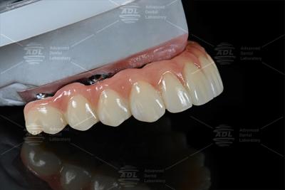 China Digital Dental Design Services Delivering Detailed Virtual Models And Customized Treatment Planning Including Crown And Bridge Design for sale