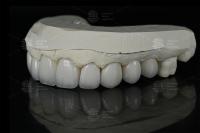 China 0.3mm-0.7mm Feldspathic EMAX Ceramic Veneers Natural Aesthetic Emax Dental Veneers for sale
