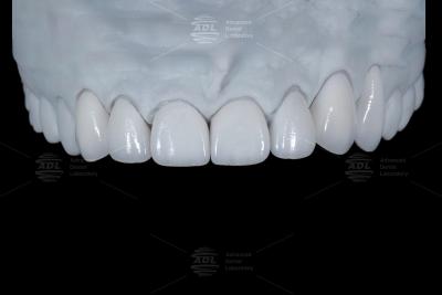 China Natural Tooth Color Ceramic Feldspathic Veneer For Anterior And Posterior Teeth for sale