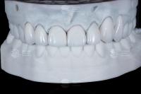 China Natural Tooth Color Ceramic Feldspathic Veneer For Anterior And Posterior Teeth for sale