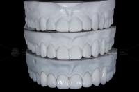 China Natural Tooth Color Ceramic Feldspathic Veneer For Anterior And Posterior Teeth for sale