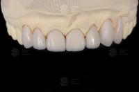 China Natural Tooth Color Ceramic Feldspathic Veneer For Anterior And Posterior Teeth for sale