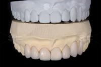China Natural Tooth Color Ceramic Feldspathic Veneer For Anterior And Posterior Teeth for sale