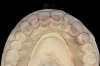 China Natural Tooth Color Ceramic Feldspathic Veneer For Anterior And Posterior Teeth for sale