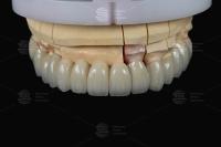 China Precise Fit High Esthetic Precious Alloy PFM Crown Porcelain Fused To Metal Crown for Dental Lab for sale