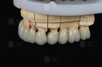 China Precise Fit High Esthetic Precious Alloy PFM Crown Porcelain Fused To Metal Crown for Dental Lab for sale