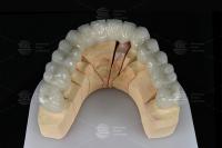 China Precise Fit High Esthetic Precious Alloy PFM Crown Porcelain Fused To Metal Crown for Dental Lab for sale