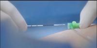 China Surgery lipolysis face lift endolaser bare fiber evlt radial fiber hemorrhoid fistula fiber for sale