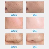 China Professional 10 in 1 Hydra Dermabrasion Tightening with Certificate CE for sale