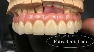 China PFM Dental Crowns Porcelain Fused to Metal Custom Restoration 1.5mm Thickness for sale