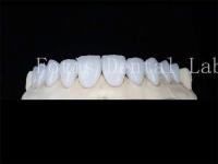 China Customized Natural Porcelain Veneers Dental Lab Veneers Stain Resistant for sale