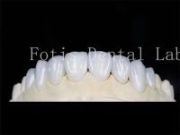 China Porcelain Dental Laminate Veneers 0.3-0.5mm Custom Cosmetic Teeth Covers for sale