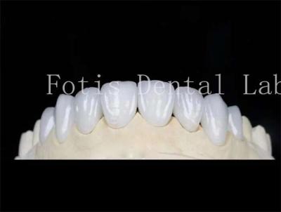 China Porcelain Dental Laminate Veneers 0.3-0.5mm Custom Cosmetic Teeth Covers for sale