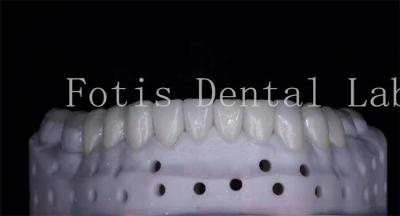 China Dental Lab Laminate Veneers 0.3-0.5mm High Strength Porcelain Veneers for Cosmetic Dentistry for sale