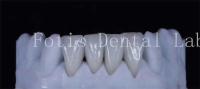 China Thin Synthetic Laminate Veneer Teeth 0.3-0.5mm Thick Beautiful  Looking for sale