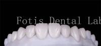 China Porcelain Dental Laminate Veneers 0.3-0.5mm for Natural Smile for sale