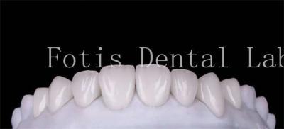 China Porcelain Dental Laminate Veneers 0.3-0.5mm for Natural Smile for sale