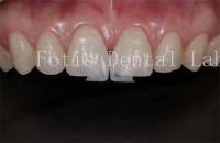 China High Translucency Dental Porcelain Laminate Veneers for Natural Smile Polishing for sale