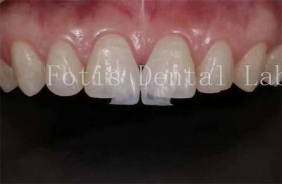 China High Translucency Dental Porcelain Laminate Veneers for Natural Smile Polishing for sale