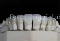 China Polished Dental Laminate Veneers High Translucency 0.3-0.5mm for Natural Smiles for sale