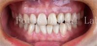 China Dental Porcelain Veneers High Stain Resistance Prosthetic Laminate Veneers for Cosmetic Dentistry for sale