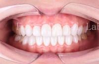 China High Translucency Dental Laminate Veneers 0.3-0.5mm Long Lasting Durability Polishing Finish for sale