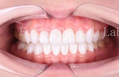 China High Translucency Dental Laminate Veneers 0.3-0.5mm Long Lasting Durability Polishing Finish for sale