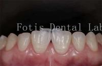 China Dental Lab Porcelain Laminate Veneers 0.3-0.5mm High Stain Resistance Polishing for sale