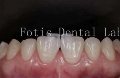 China Dental Lab Porcelain Laminate Veneers 0.3-0.5mm High Stain Resistance Polishing for sale
