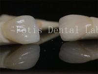 China Long-lasting Dental Lab Laminate Veneers Customizable for Various Tooth Preparations for sale