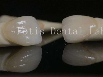 China Long-lasting Dental Lab Laminate Veneers Customizable for Various Tooth Preparations for sale