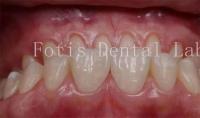 China Dental Lab Laminate Veneers 0.3-0.5mm Porcelain Cosmetic Teeth Covers for Natural Smile for sale