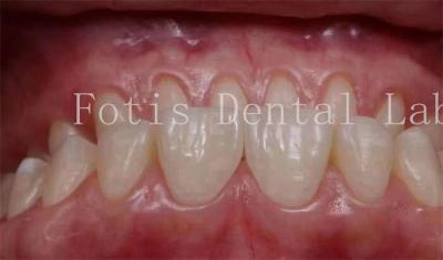 China Dental Lab Laminate Veneers 0.3-0.5mm Porcelain Cosmetic Teeth Covers for Natural Smile for sale